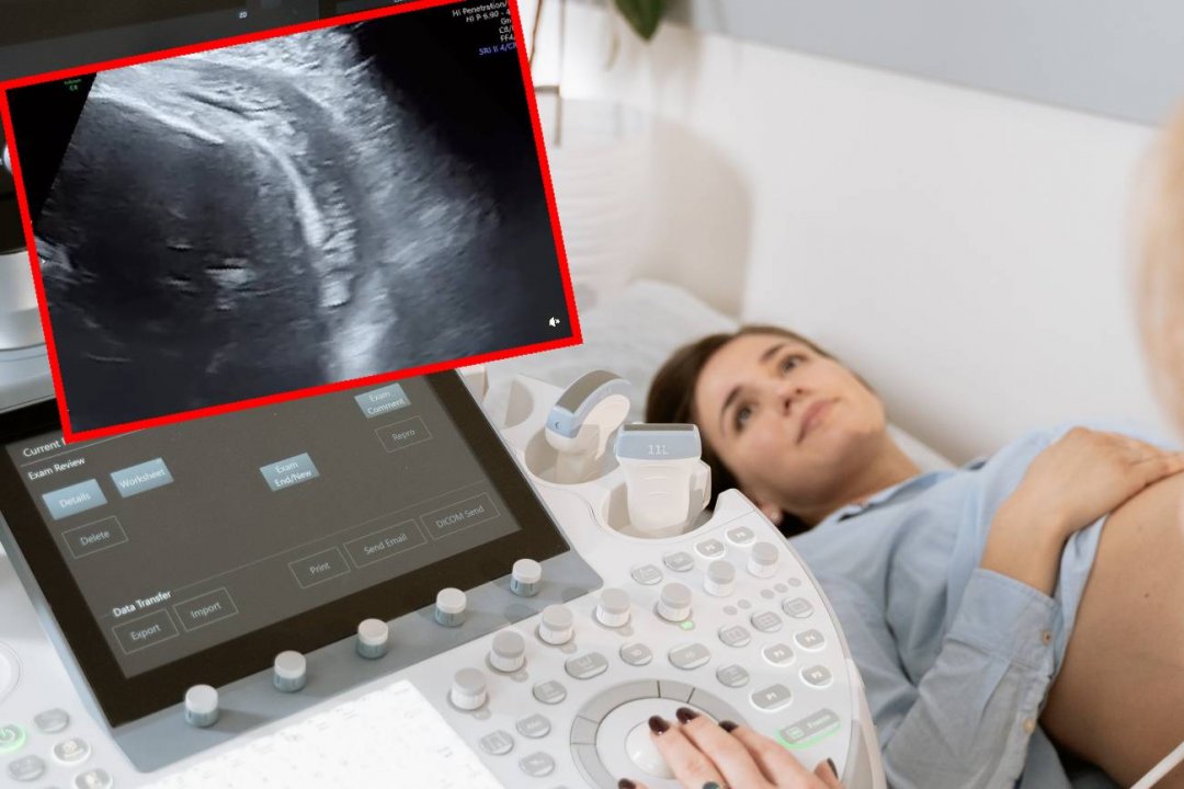 Dziecko na USG w ciąży: lekarz pokazuje, że czasem widać nawet włosy ...